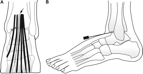 Mr Arthrography Of The Ankle Indications And Technique Radiologic Clinics