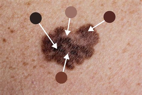 What Melanoma Looks Like With Pictures 5 Signs Tua Saúde