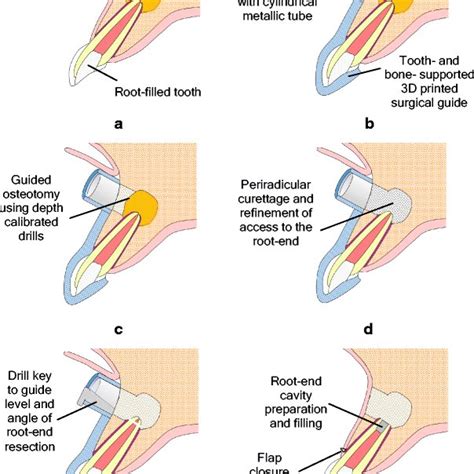 A Left A Surgical Endodontics Procedure Using 3d Printed Guide A