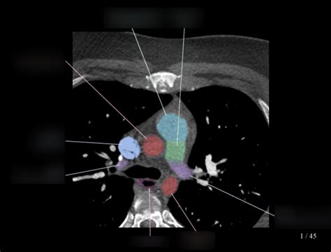 Radiology Case Stack 12 Axial Cardiac Ct 1 Diagram Quizlet