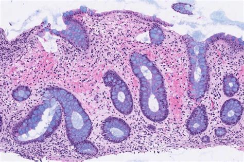 Ischemic Colitis Microscopic Pathology