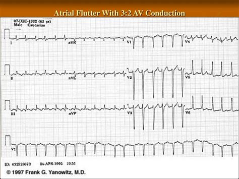 Ppt Electrocardiogram Powerpoint Presentation Free Download Id 297761