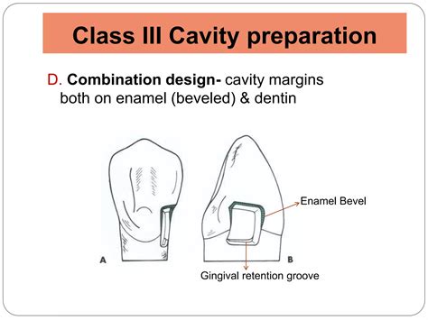 Class Iii Iv V Cavity Preparations For Composites Selvi Pptx
