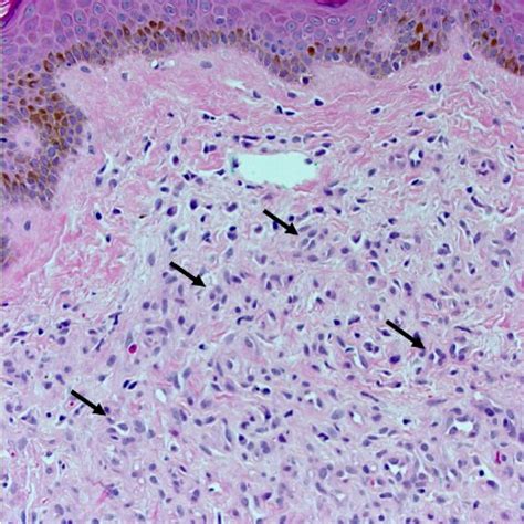 Left Breast Of A Patient With Diffuse Dermal Angiomatosis Note The Red Download Scientific