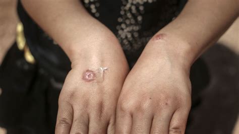 Sand Fleas Bites Spreading
