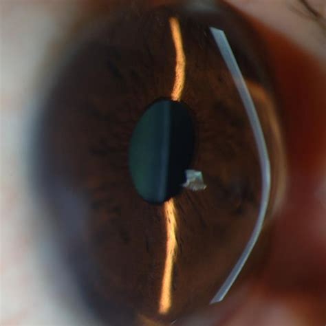 Keratoconus