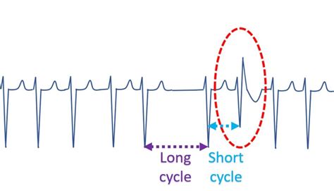 Ashman Phenomenon In Atrial Fibrillation All About Cardiovascular
