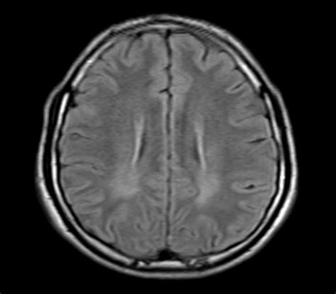 Unveiling Cerebrotendinous Xanthomatosis Of Young Adult A Case Report