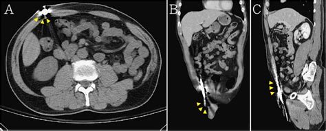 Abdominal CT Demonstrated That The Penetration Extended From The Left Download Scientific