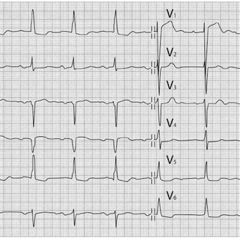 Typical Ecg Of A‐iab P Wave ± In Leads Ii Iii And Avf And Duration