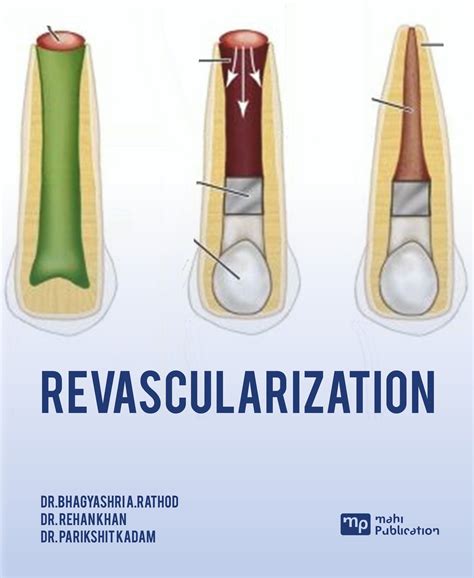 Revascularization Drbhagyashri Arathoddr Rehan Khandr Parikshit