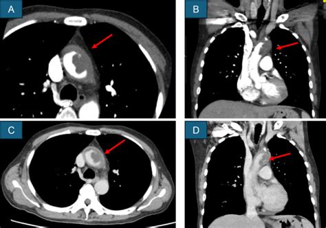 Aortic Intimal Sarcoma Diagnosed By Surgical Resection Pmc