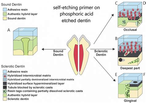 Sclerotic Dentin
