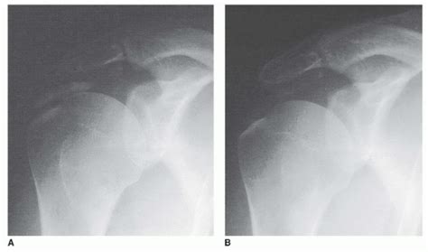 Arthroscopic Calcium Excision Musculoskeletal Key