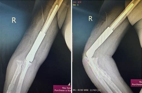 ГССҮТ ийн эмч нар тохойн үе зэргийг хиймлээр солих мэс засал шинээр нэвтрүүлэв