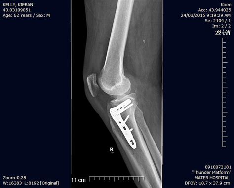 Tibial Plateau Fracture Surgery Renew Physical Therapy