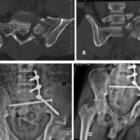 Comparison Between Denis Ao Spine And Islers Classification Denis
