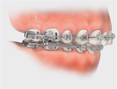 Orthodontic Forsus At Jamie Spinelli Blog