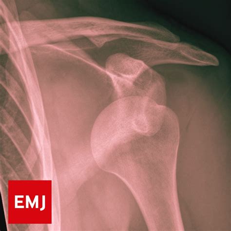 📝 What Should Be Documented For An Anterior Shoulder Dislocation Bmj Emergency Medicine