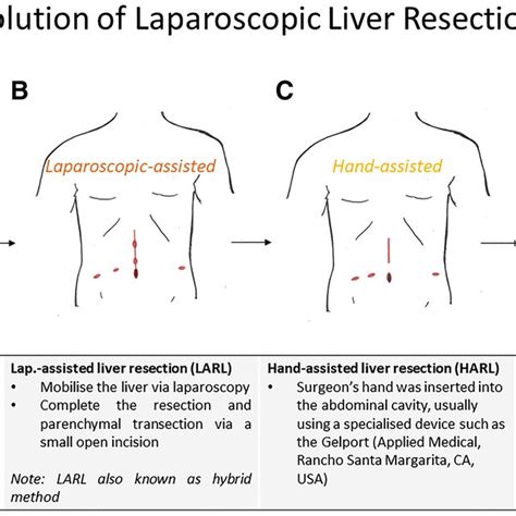 Evolution Of Laparoscopic Liver Resection Exemplary Illustration Of