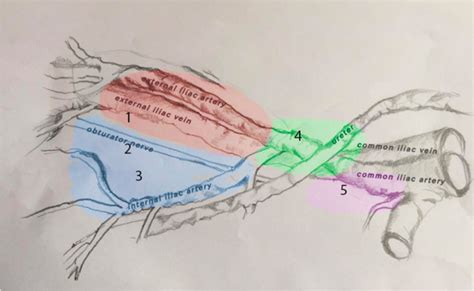 Extended Pelvic Lymph Node Dissection During Robotic Prostatectomy