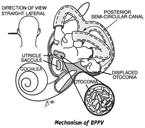 Benign Paroxysmal Positional Vertigo El Paso Tx