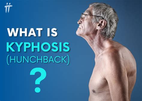 What Is Kyphosis Hunchback Treatment And Surgery Turanandturan