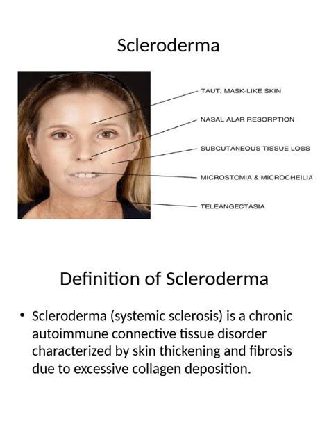Understanding Scleroderma Types And Treatment Pdf Medical