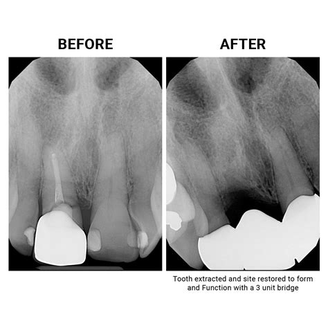 Horizontal Root Fracture Schwenksville Dental Care