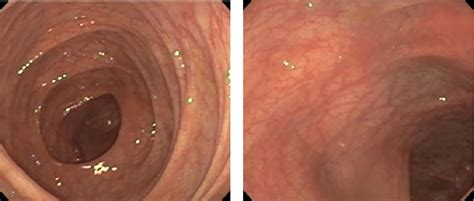 Normal Colon Endoscopy