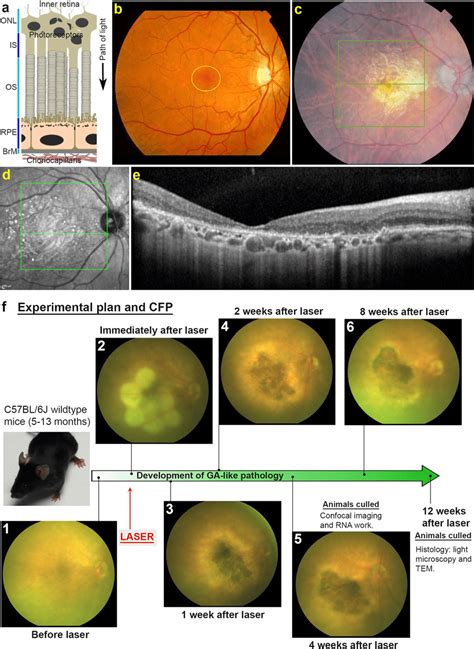 The Anatomy Of Geographic Atrophy Ga And Development Of Ga Like