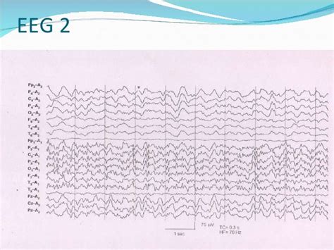 Eeg Basics