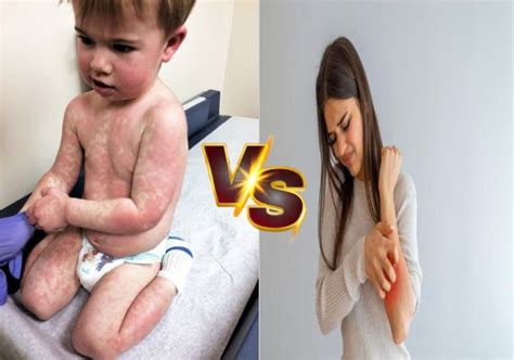 Top 11 Reasons For Immediate And Delayed Hypersensitivity Keydifference