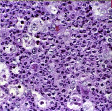 Lecture 15 Inflammation Flashcards Quizlet