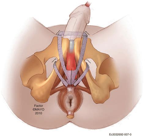 C F Gif Abdominal Key