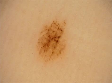 Dermoscopic Patterns Of 158 Acral Melanocytic Nevi In A Latin American Population Actas Dermo