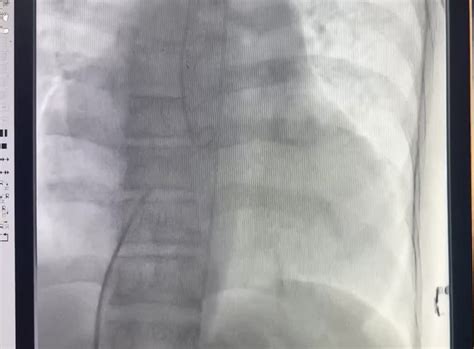 Nipin K M On Linkedin Bmv 40y M Severe Ms Balloon Used 26mm