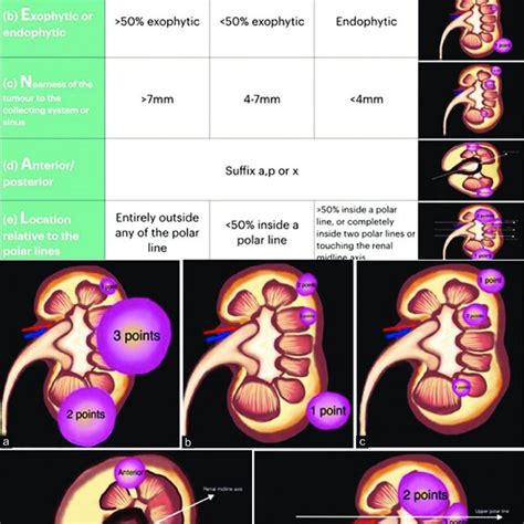 The Components Of Renal Nephrometry Score Here Under The Heading Download Scientific Diagram