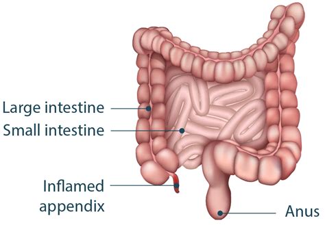 Appendix Infection Symptoms