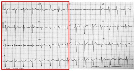 The Qrs Axis Deranged Physiology