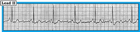 ECG Interpretation ECG Blog Atrial Flutter AV Block Artifact Sinus Rhythm