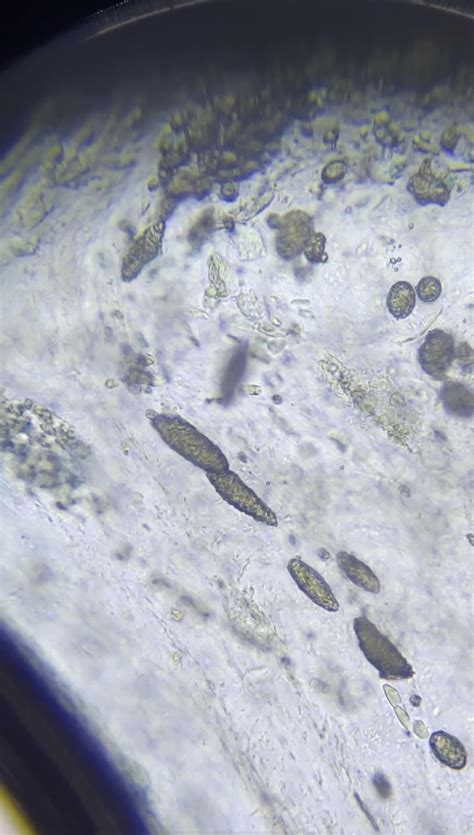 Sputum Sample From My Daughter Some Look Like Turds Others Like Eggs