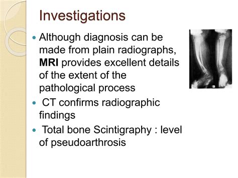 Pseudoarthrosis Of Tibiapptx Death Injury Or Military Conflict