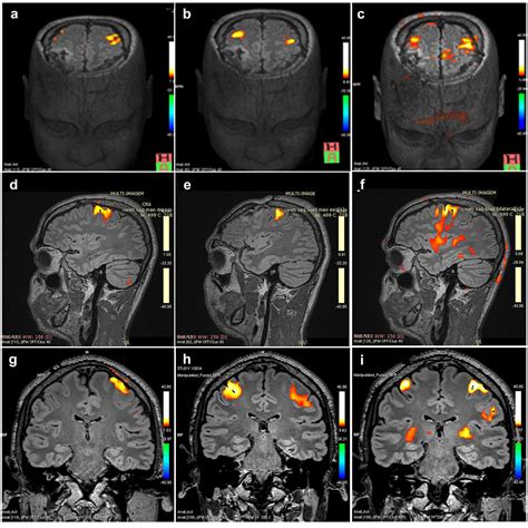 Frontal Lobe Damage Loss Of Motor Function