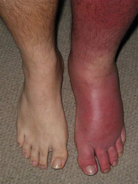 9 Best Cellulitis Leg Images On Pinterest Cellulitis Infection