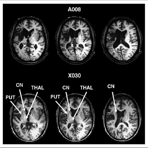 T1 Weighted Mris Both Patients Showed Lesions Of Left Perisylvian Download Scientific Diagram