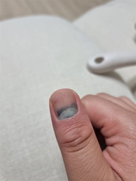 차문에 손가락 찍힘 손톱안에 피멍 지식in