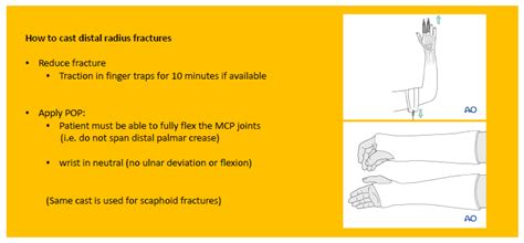 Scaphoid Fractures Mtwortho
