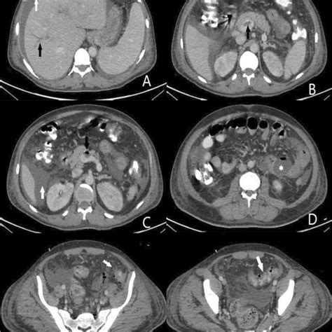 Accessory Peritoneal Membrane Black Arrows Download Scientific Diagram