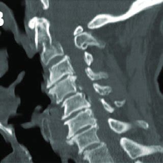 Initial CT Of Case Head CT Shows An Acuteon Chronic Left Convexity Download Scientific